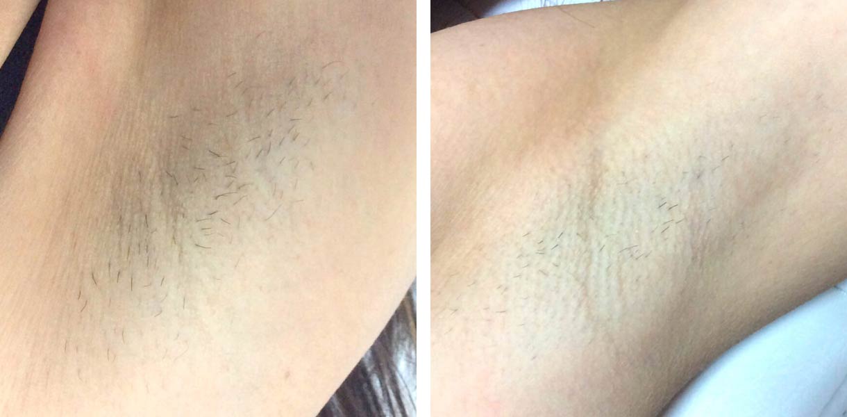 Laser Hair Removal – Precision Laser Clinic